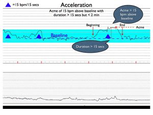 Basic Pattern Recognition – Electronic Fetal Monitoring