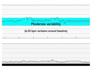 Basic Pattern Recognition – Electronic Fetal Monitoring