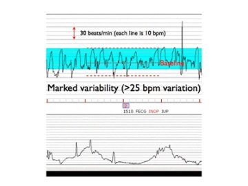 Basic Pattern Recognition – Electronic Fetal Monitoring